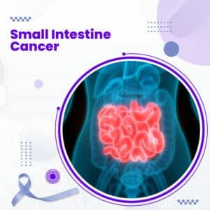 Small Intestine Cancer , Signs and Symptoms | Uhapo
