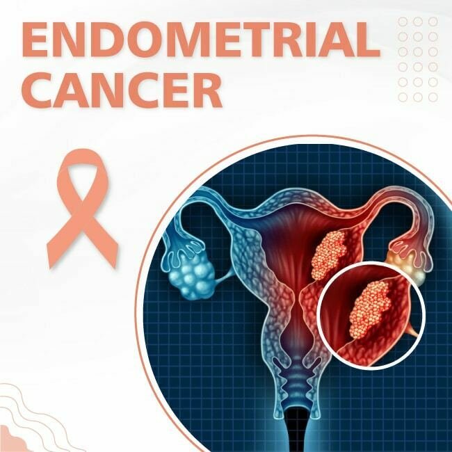 Stage Ivb Endometrial Cancer