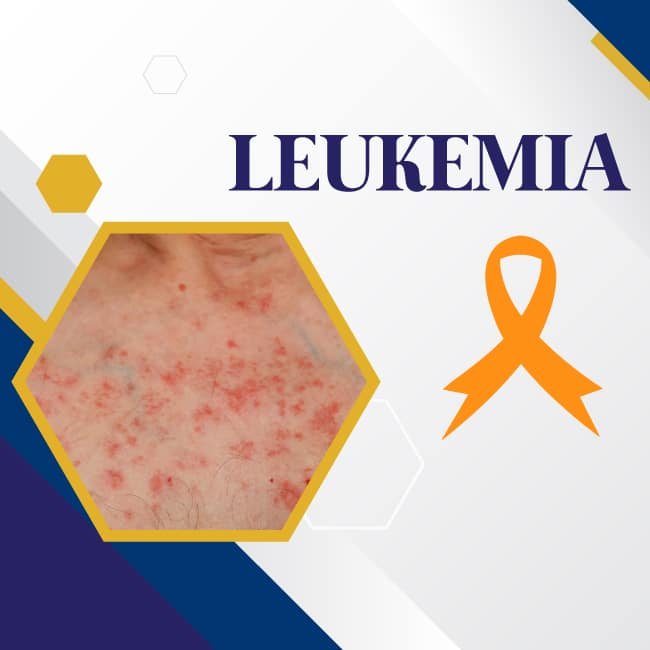 Leukemia - UHAPO