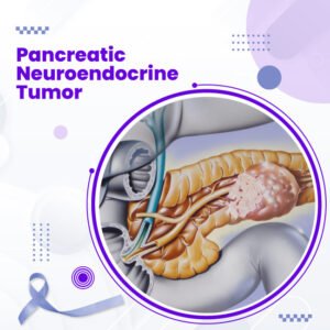 Pancreatic Neuroendocrine Tumor - UHAPO